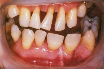 Dişin Yapısı, Özellikleri ve Diş Hastalıkları » Bilgiustam