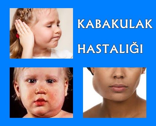 Kabakulak Hastalığı Belirtileri Ve Tedavisi » Bilgiustam