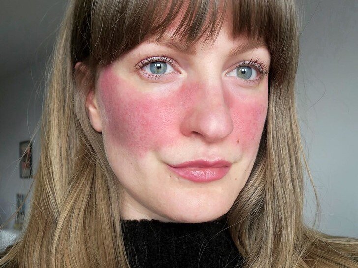 Rosacea (Roza) Hastalığı Nedir, Nasıl Bir Hastalıktır, Tedavisi Nasıl ...